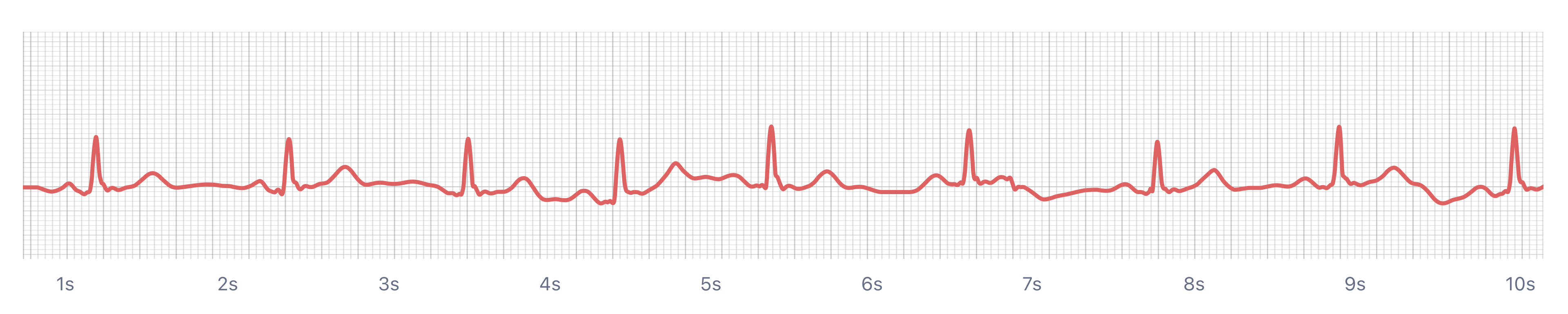 What Second-Degree AV Block Type 2 Looks Like on Your Watch ECG | Qaly